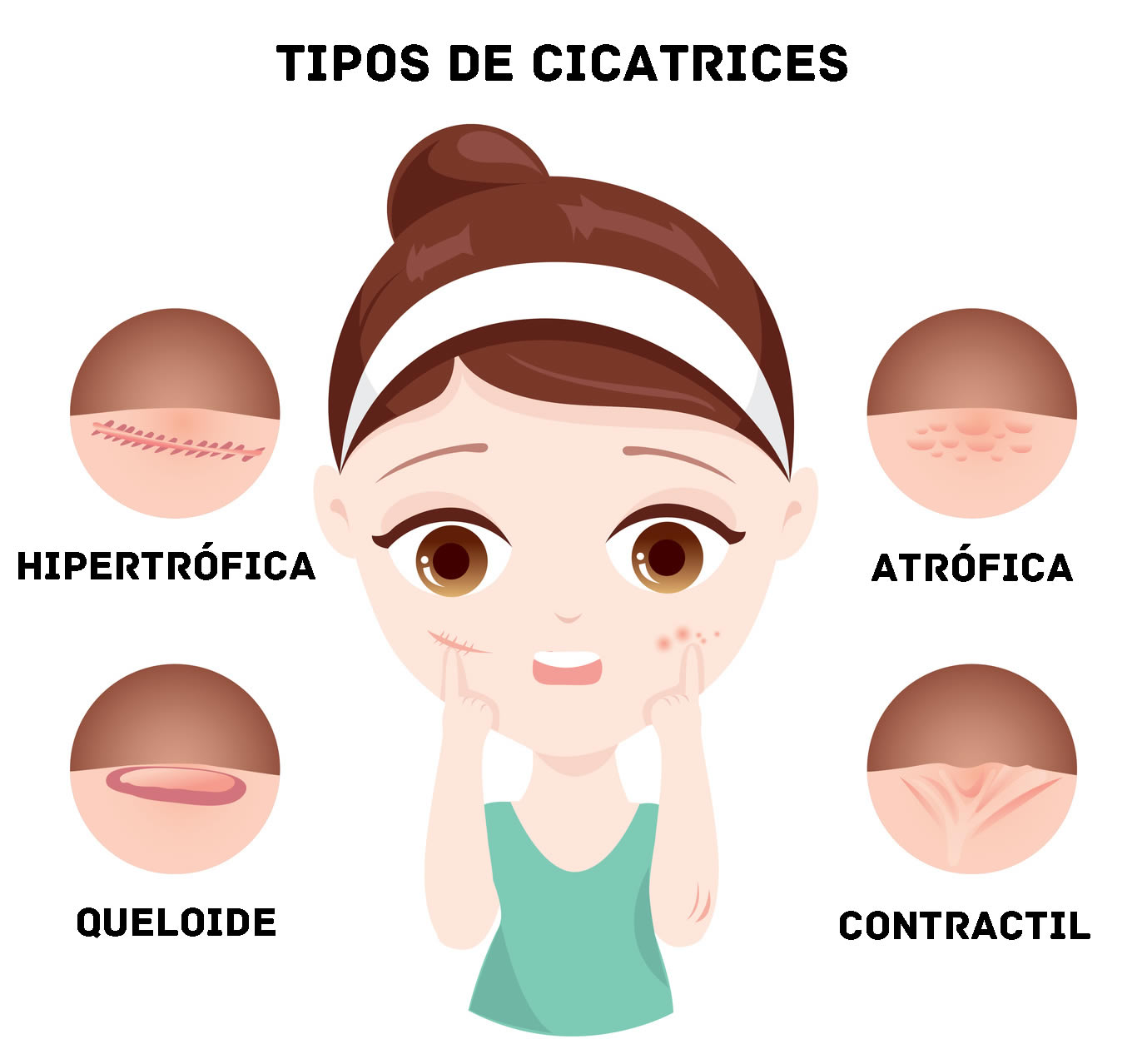Cicatriz Atr fica Hipertr fica Y Queloide Definici n Concepto Y Qu Es
